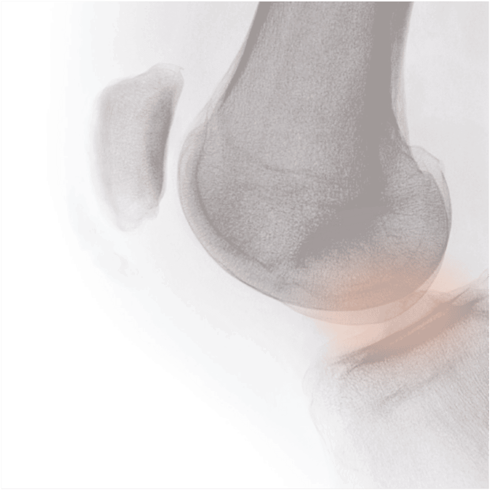 Lipocell - Traumatologie und Orthopädie Mallorca